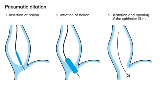 Achalasia Treatment | PortalCLÍNIC