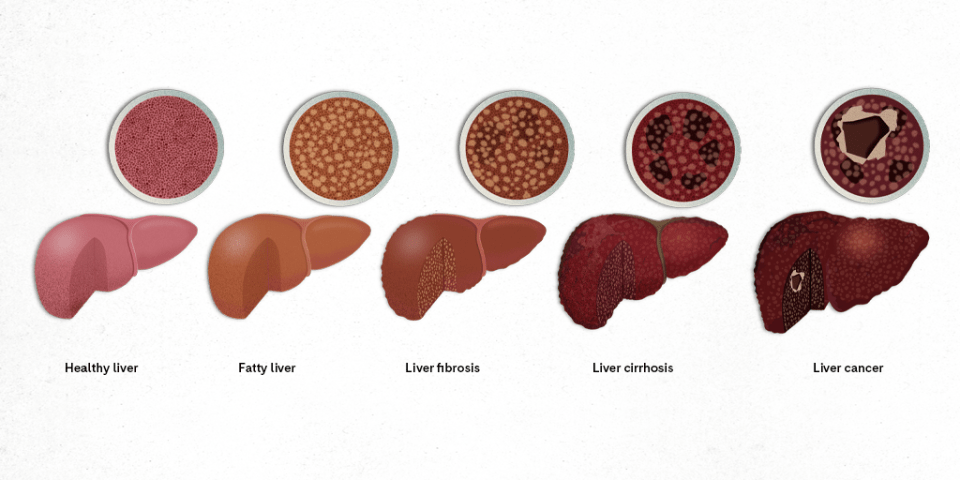 What is liver cirrhosis?