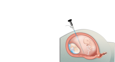 Tratamiento del Síndrome de Transfusión Feto Fetal | Hospital Clínic ...