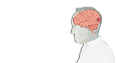 Tumor cerebral | ¿Qué es un Tumor en el Cerebro? | PortalCLÍNIC