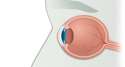 Tests and diagnosis of Uveitis