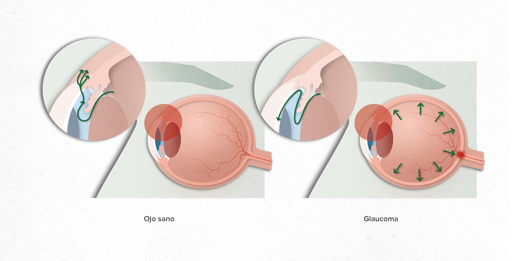 ¿qué Es El Glaucoma Hospital Clínic Barcelona