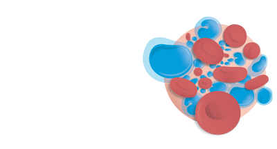 Diagnóstico de la Leucemia Mieloide Aguda | Hospital Clínic Barcelona