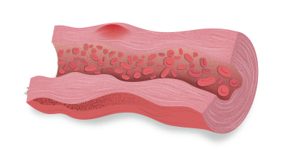 Vasculitis | Causas, Síntomas, Tratamiento | PortalCLÍNIC