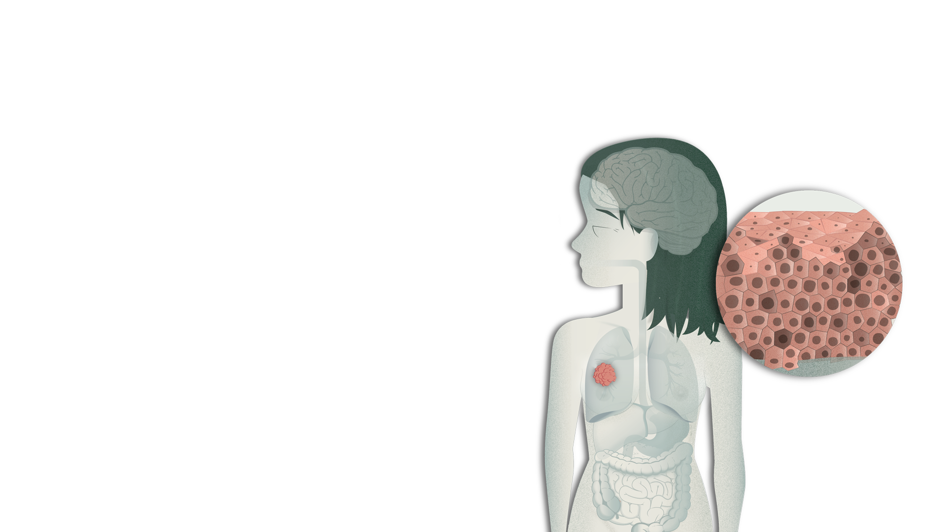 Causas del Cáncer | PortalCLÍNIC