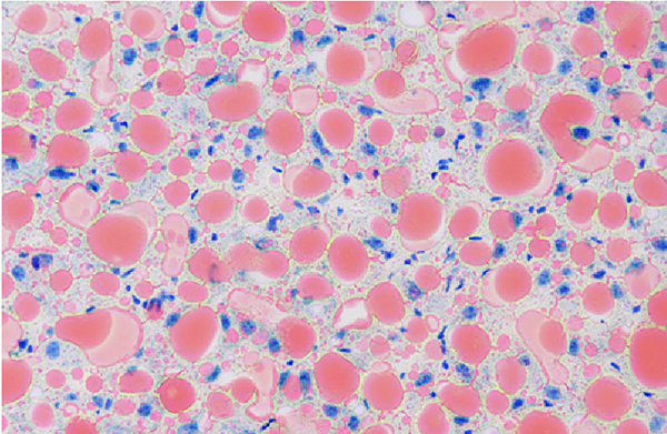 Researchers discover a protein that protects against fatty liver, the ...