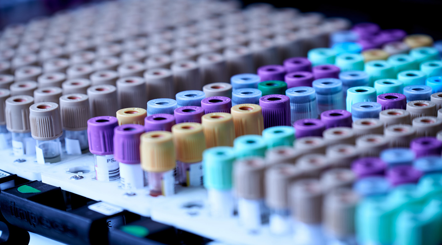 Biopsia líquida, la técnica más sensible y menos invasiva para analizar ...