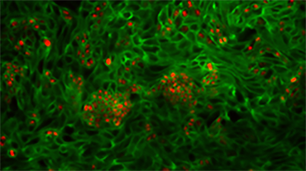 ¿Qué investigación se realiza en enfermedad inflamatoria intestinal ...