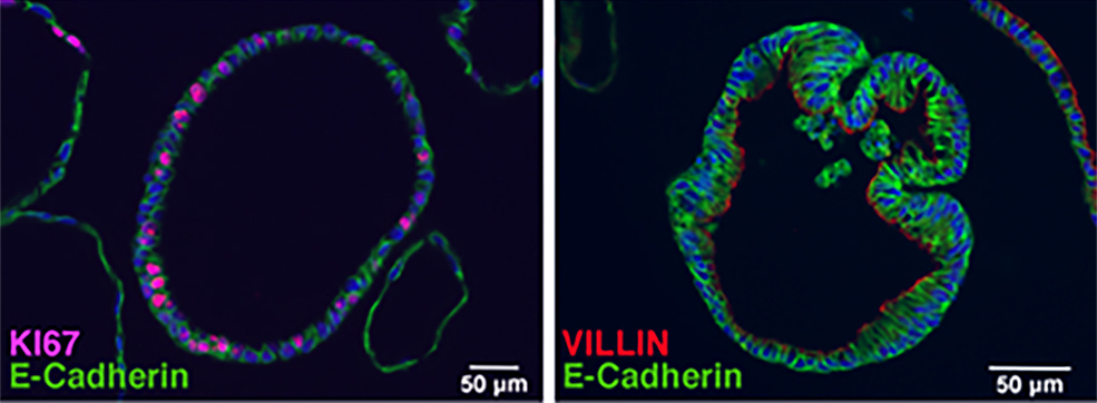 ¿Qué investigación se realiza en enfermedad inflamatoria intestinal?