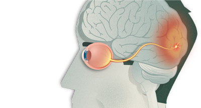 Neuritis Óptica | PortalCLÍNIC