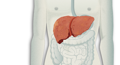 Causas y factores de riesgo del hígado graso | PortalCLÍNIC