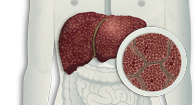 Tratamiento de la Cirrosis hepática