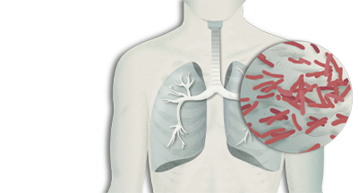 Causas y factores de riesgo | PortalCLÍNIC