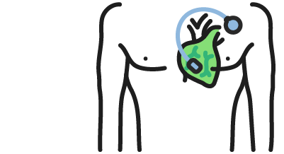 Marcapasos | ¿Qué es un Marcapasos? | PortalCLÍNIC