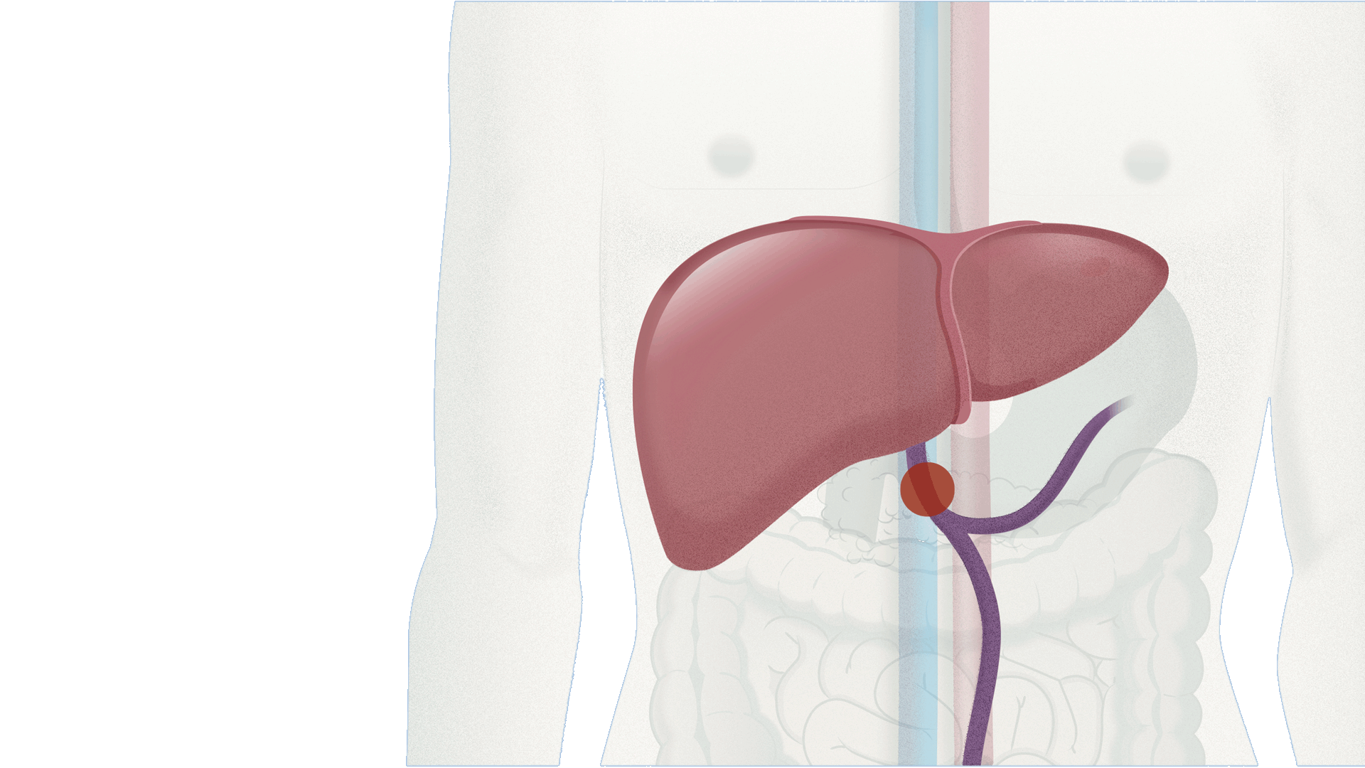 Portal Vein Thrombosis causes and risk factors | PortalClínic