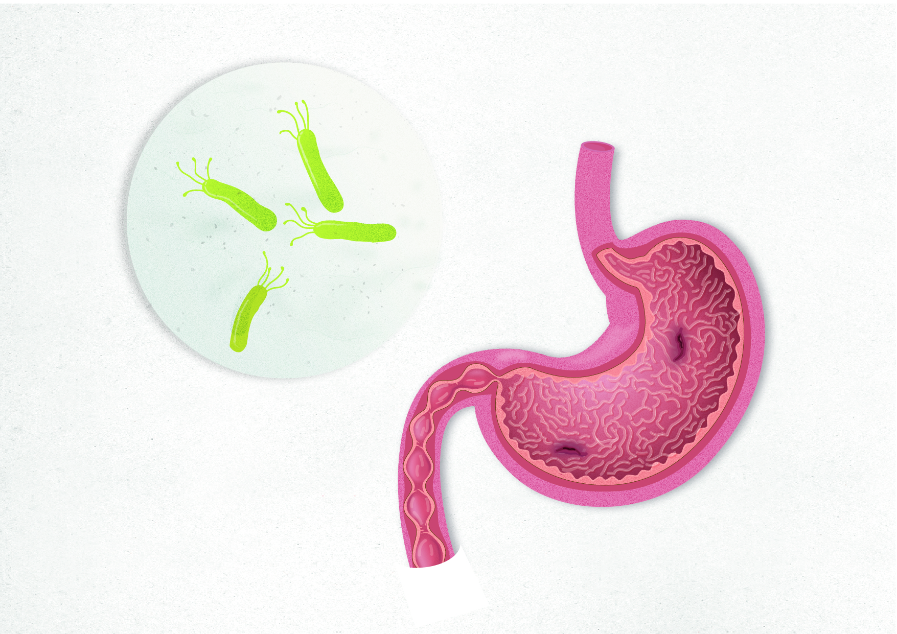 Frequently asked questions about Helicobacter pylori infection ...